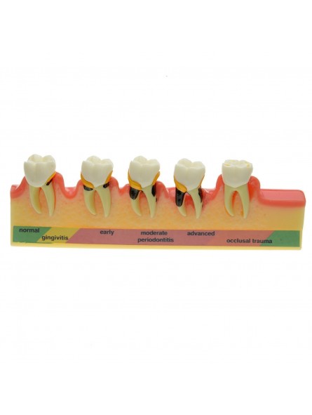 dental education model|dental models for patient education|dental ...