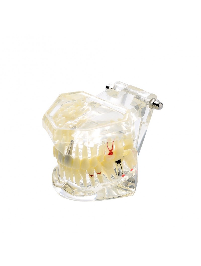 dental education models Easyinsmile Transparent Dental Implant Disease ...