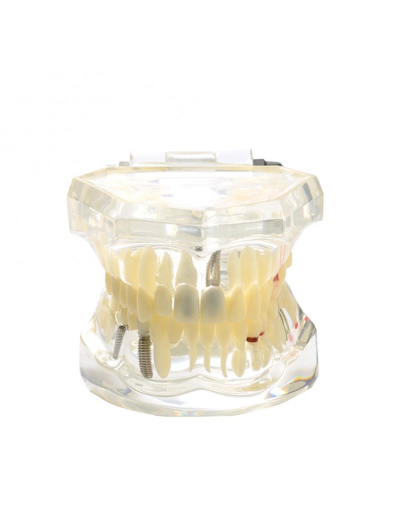 dental education models Easyinsmile Transparent Dental Implant Disease ...