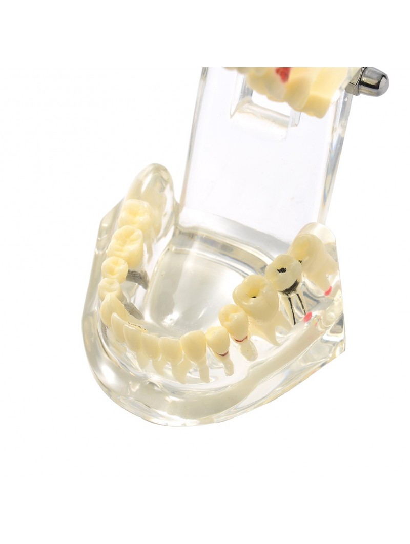dental education models Easyinsmile Transparent Dental Implant Disease ...