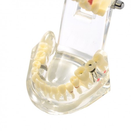 US$20.99 This is an very useful demonstration model for implanting ...