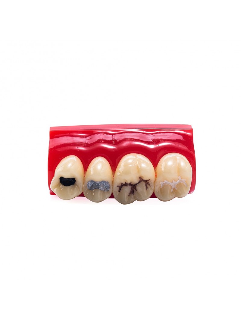 Tooth Model Of EASYINSMILE Dental Cavity Sealing Demonstration Tooth ...