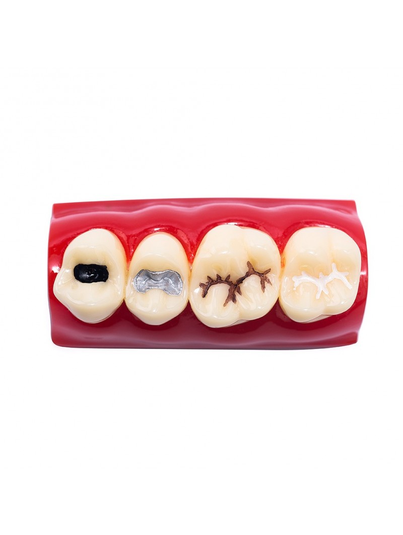 Tooth Model Of EASYINSMILE Dental Cavity Sealing Demonstration Tooth ...