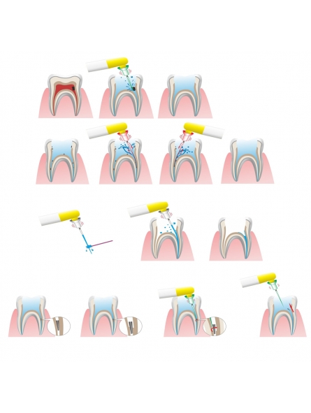 Dental Endodontic Endo Easydo Activator Ultrasonic Sonic Irrigator ...