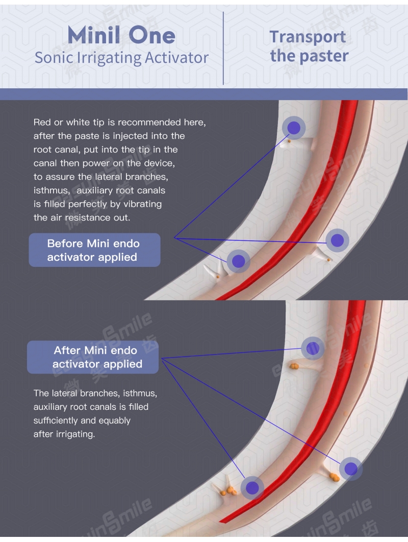 Easyinsmile Endodontic EASYDO Endo Activator Oral Mini Sonic Irrigator With 45pc Soft Tips ...
