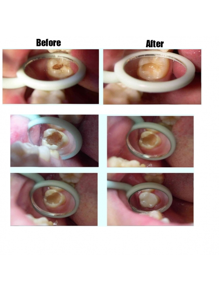 Easyinsmile Dental Material Cariesolut Gel 1G for Teeth Caries Remover ...