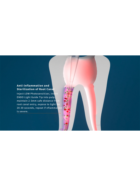 Matrix bands,Dental Photodynamic Therapy,DENTAL RESTORATION
