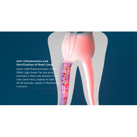 Matrix bands,Dental Photodynamic Therapy,DENTAL RESTORATION