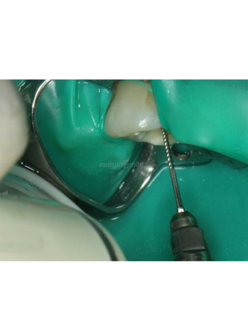 Dental Endodontic Ultrasonic Scaler Tip Files Endo Root Canal Cleaning ...